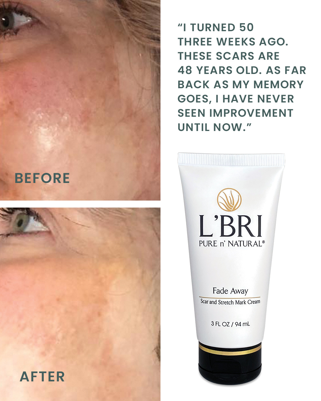 Fading Scars and Stretch Marks